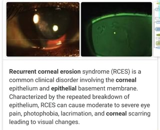 Recurrent corneal erosion syndrome (RCES) is a common clinical disorder ...