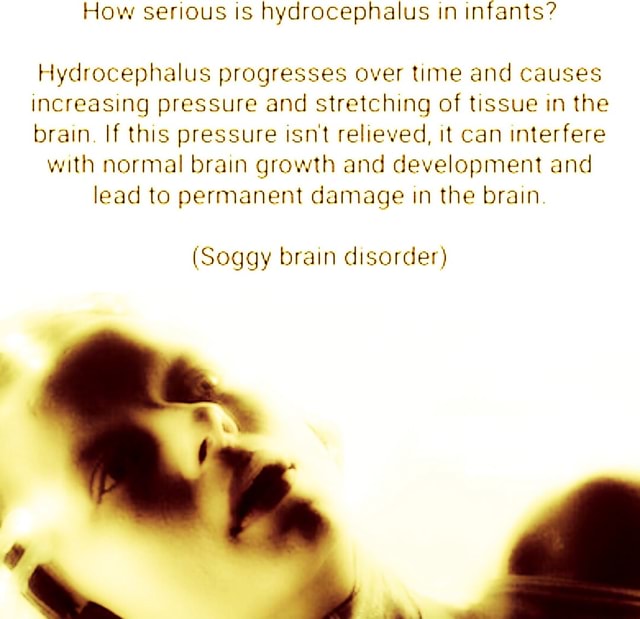 How serious is hydrocephalus in infants? Hydrocephalus progresses over ...