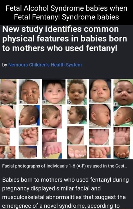 Fetal Alcohol Syndrome babies when Fetal Fentanyl Syndrome babies New ...