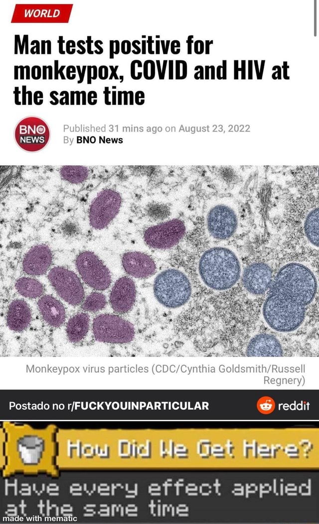 WORLD Man tests positive for monkeypox, COVID and HIV at the same time ...