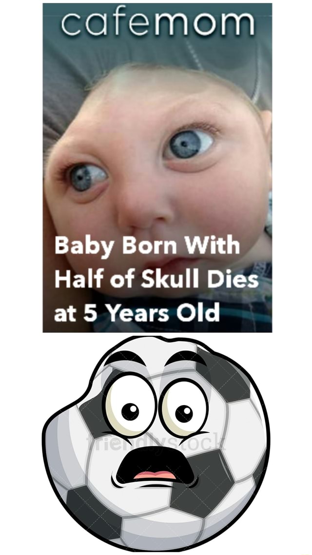 Baby Born With Half of Skull Dies at 5 Years Old - iFunny