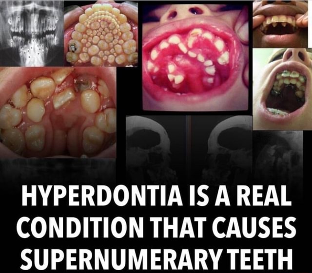 HYPERDONTIA IS A REAL CONDITION THAT CAUSES SUPERNUMERARY TEETH - iFunny