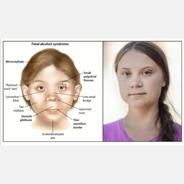 Fetal alcohol syndrome "Railroad track" ears Epicanthal folds Flat ...
