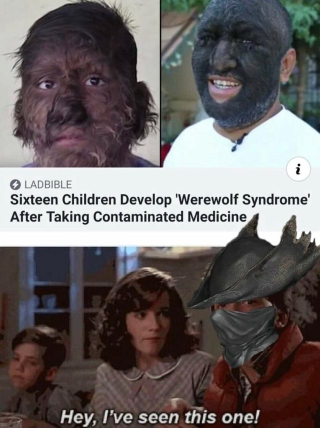 LADBIBLE Sixteen Children Develop 'Werewolf Syndrome After Taking ...