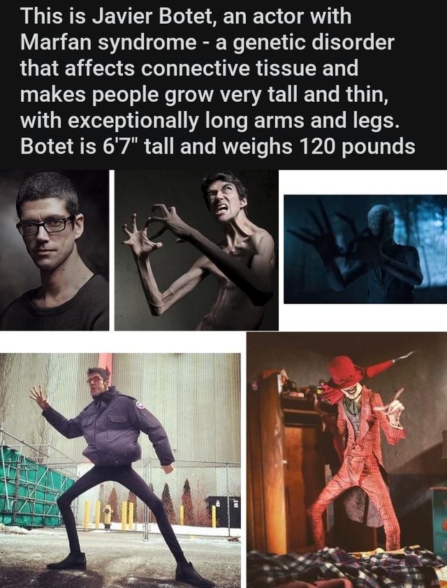 This is Javier Botet, an actor with Marfan syndrome - a genetic ...