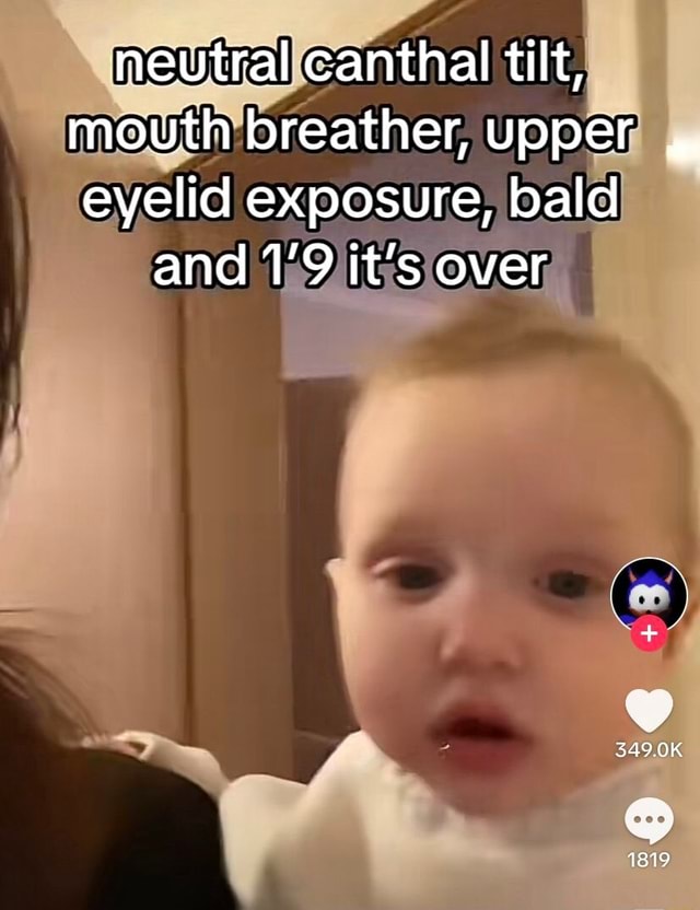 Neutral canthal tilt, mouth breather, upper eyelid exposure, bald and 1 ...