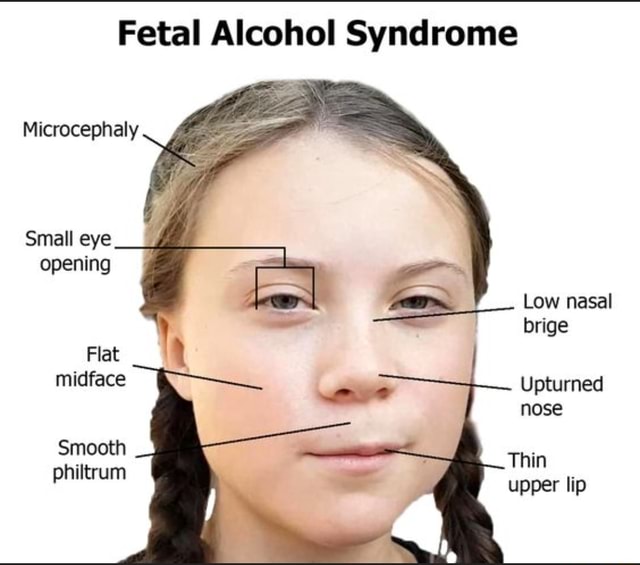 Fetal Alcohol Syndrome Microcephaly Small eye opening Low nasal Flat ...
