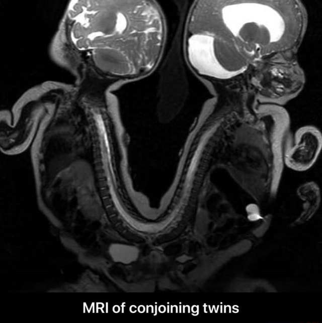MRI of conjoining twins - MRI of conjoining twins - iFunny