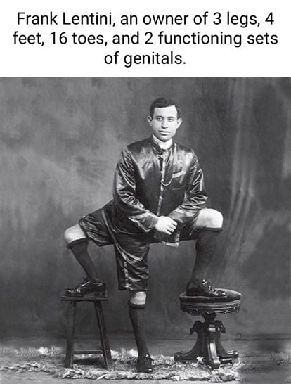 Frank Lentini, an owner of 3 legs, 4 feet, 16 toes, and 2 functioning ...