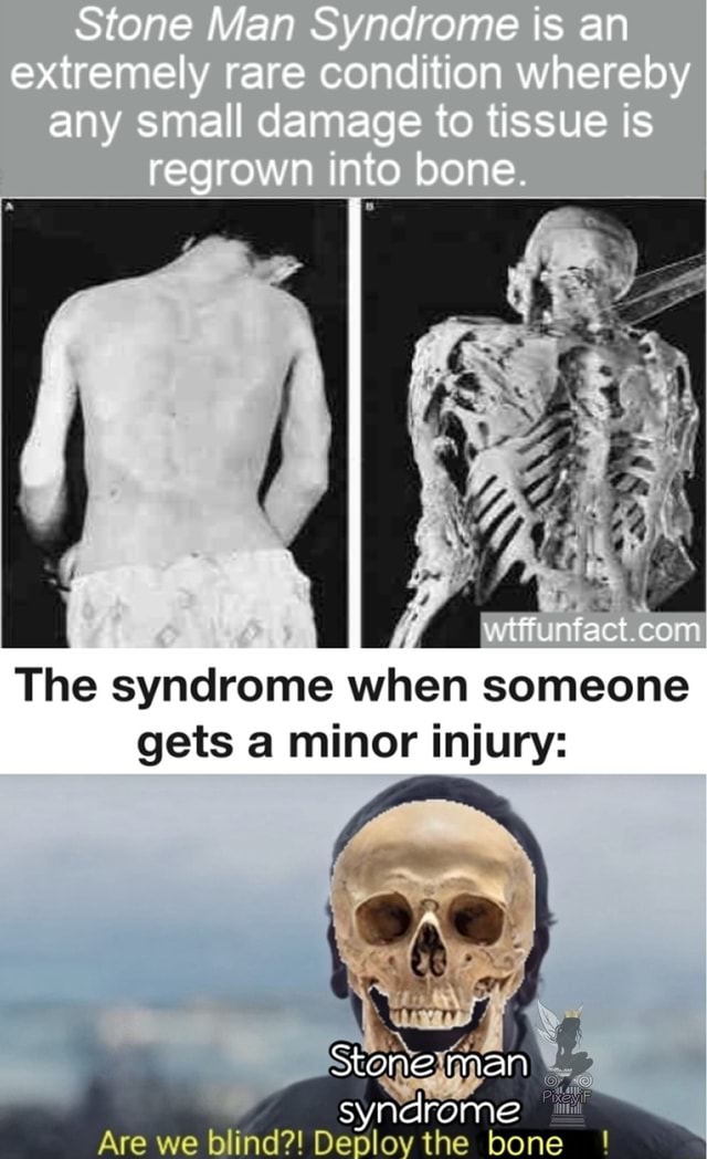 Stone Man Syndrome Is an extremely rare condition whereby any small ...