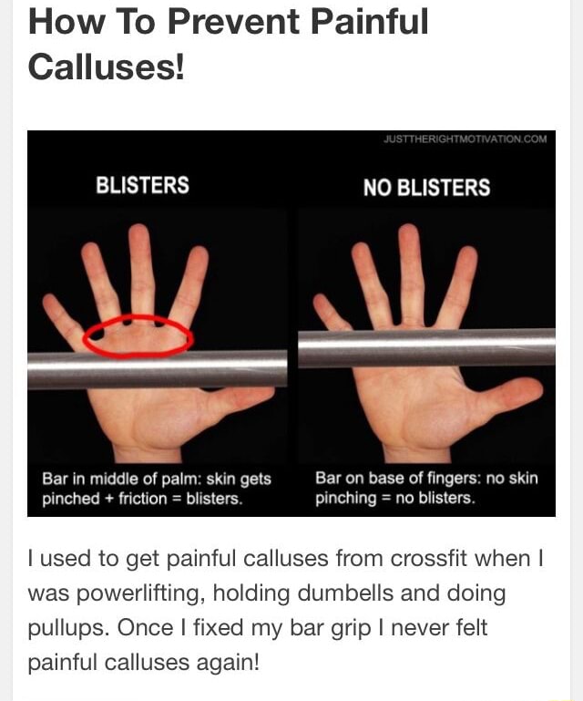 How To Prevent Painful Calluses! BLISTERS NO BLISTERS Bar in middle of ...