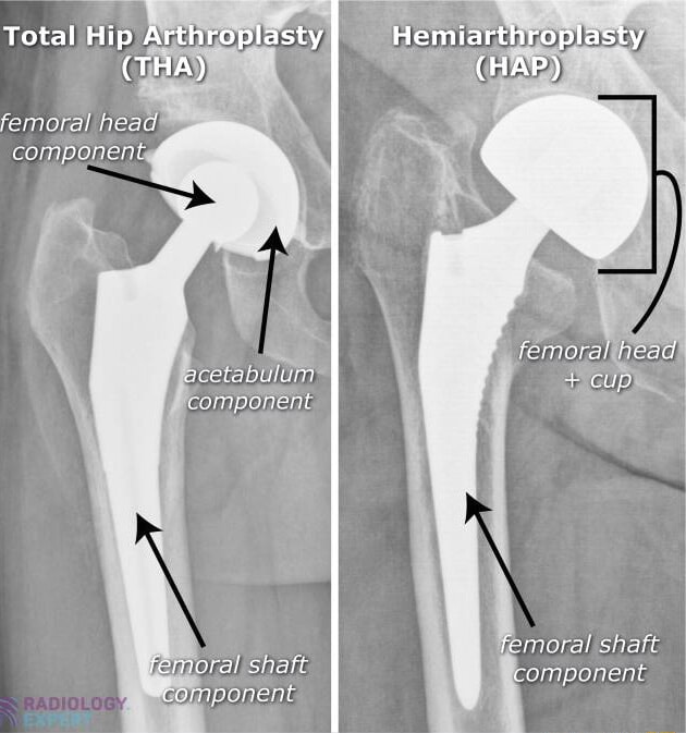 Total Hip femoral head component CHAP) cetabulum component femoral ...