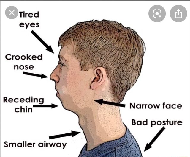 Tired eyes Crooked nose Receding chin Narrow face Bad posture Smaller ...