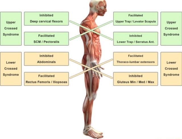 Inhibited Upper Deep cervical flexors Crossed Syndrome Facilitated SCM ...