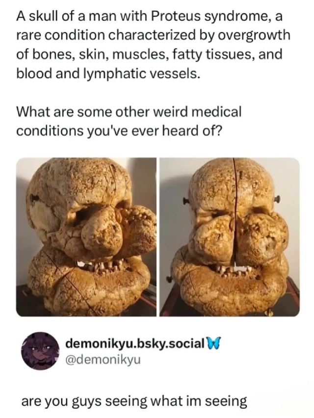 A skull of a man with Proteus syndrome, a rare condition characterized ...