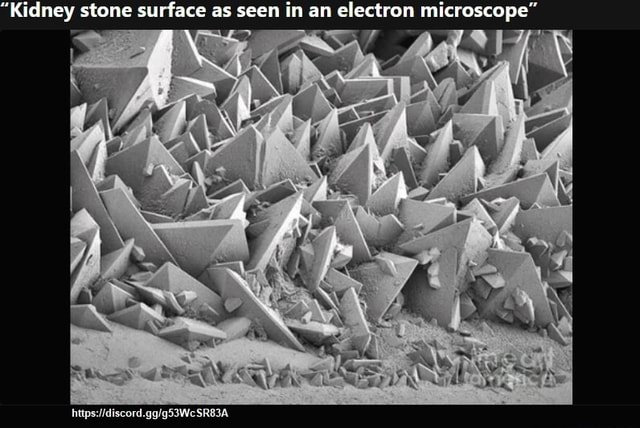 Kidney stone surface as seen in an electron microscope" - iFunny