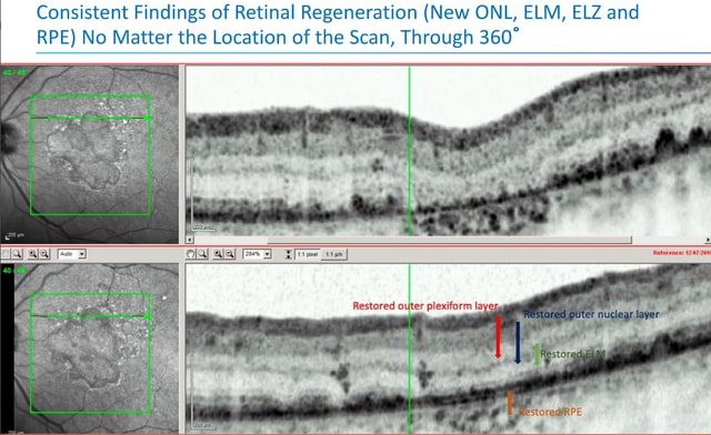 OCT imaging demonstrating regeneration of multiple retinal layers that ...