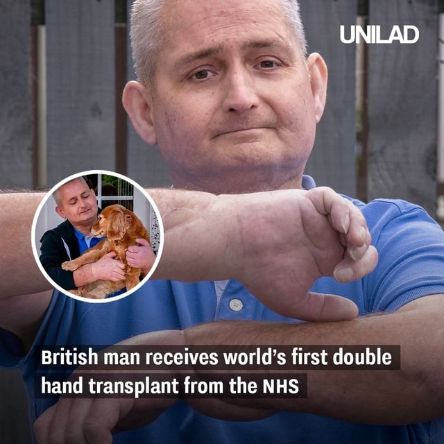 British man receives world's first double hand transplant from the NHS ...