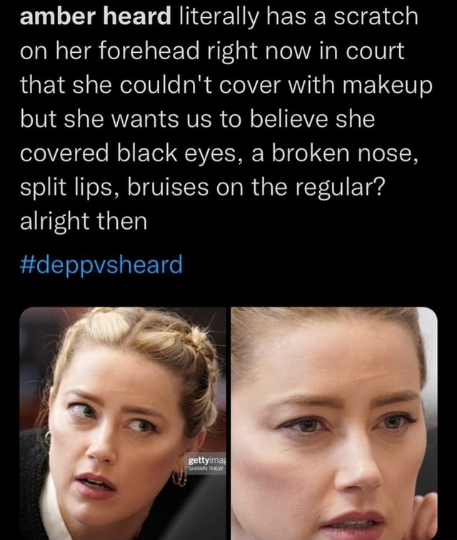 Amber heard literally has a scratch on her forehead right now in court ...