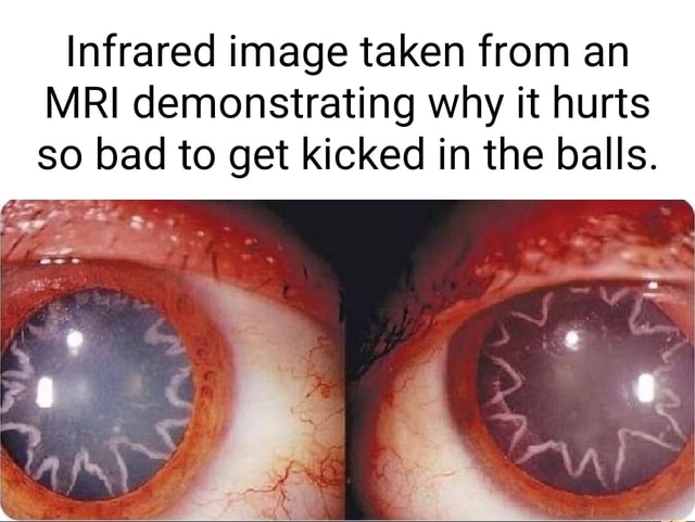 Infrared image taken from an MRI demonstrating why it hurts so bad to ...