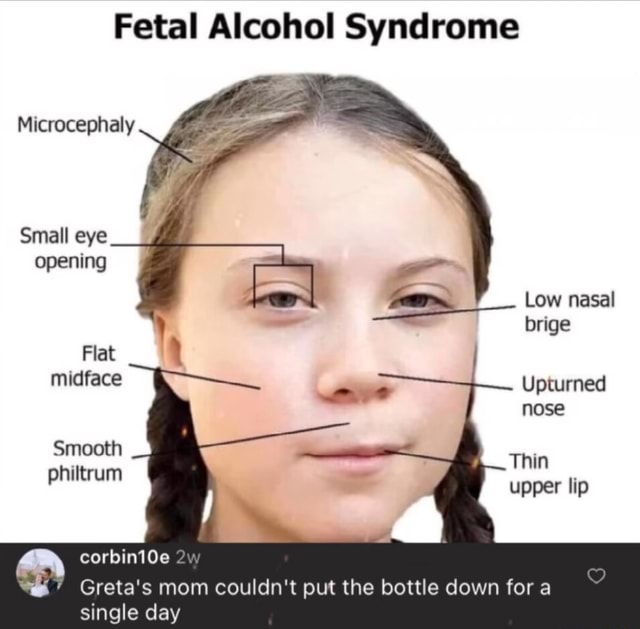 Fetal Alcohol Syndrome Microcephaly Small eye opening Low nasal brige ...