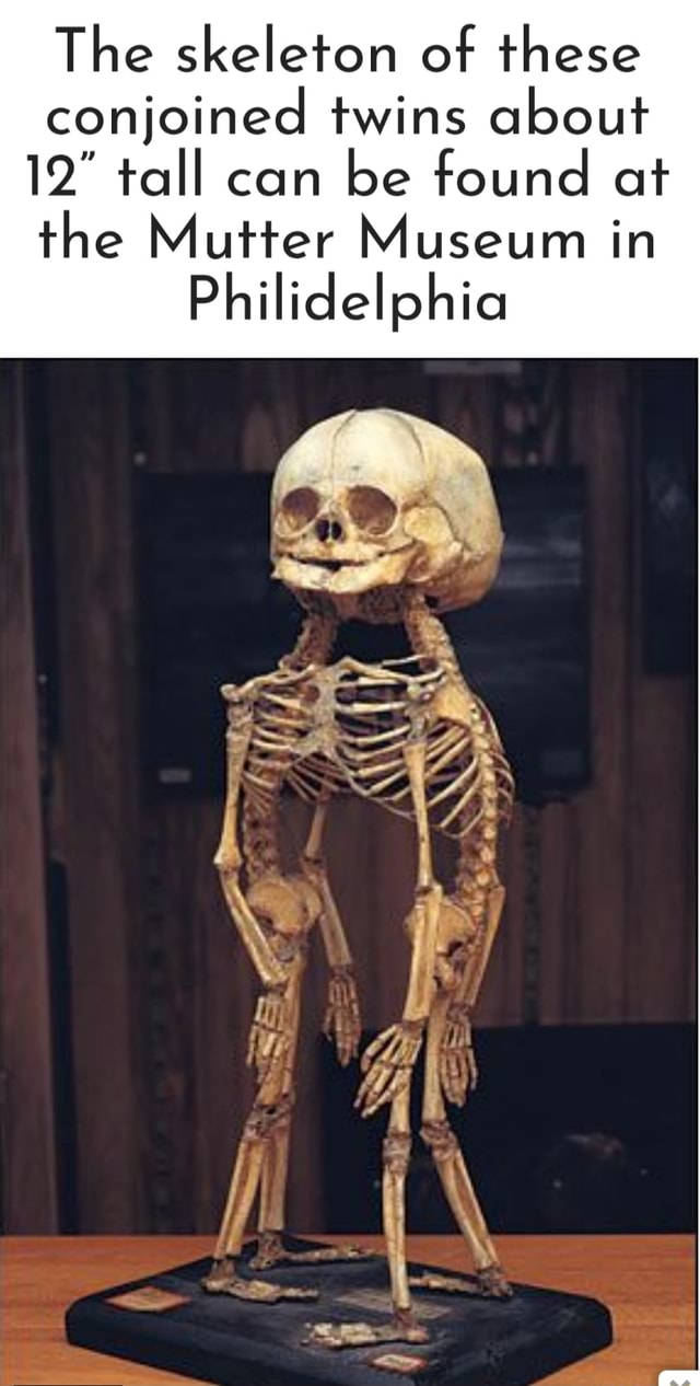 The skeleton of these conjoined twins about 12" tall can be found at ...