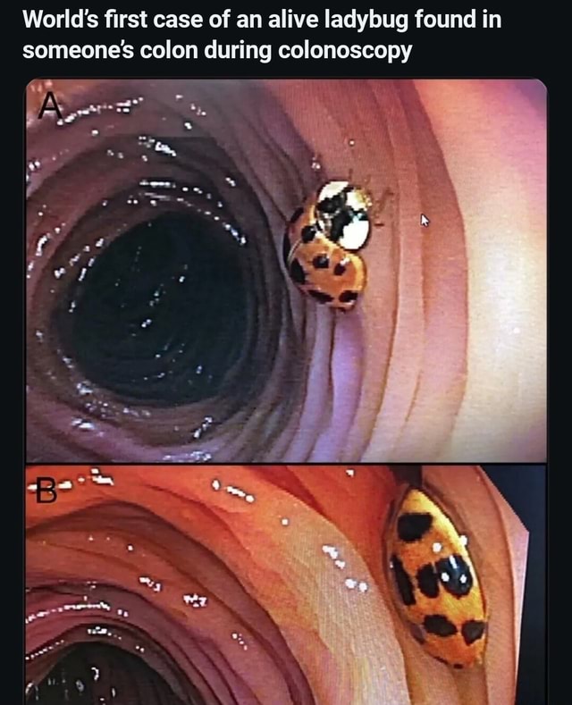 World's first case of an alive ladybug found in someone's colon during ...