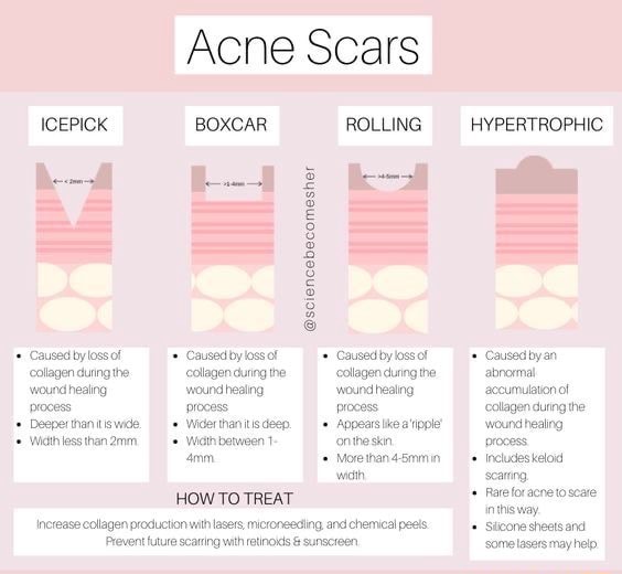 Acne Scars ICEPICK BOXCAR ROLLING HYPERTROPHIC hR-A -t: ofe ...
