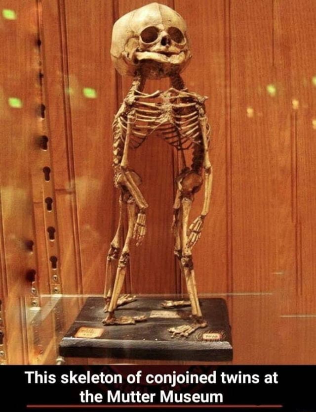 This skeleton of conjoined twins at the Mutter Museum - iFunny