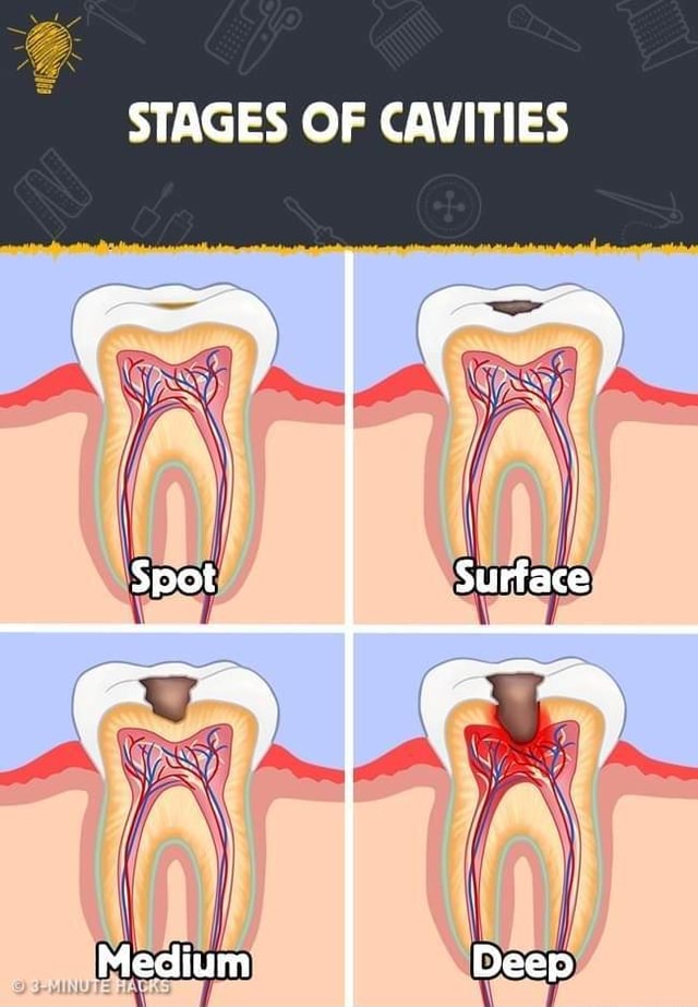 STAGES OF CAVITIES Medium Deep - America’s best pics and videos