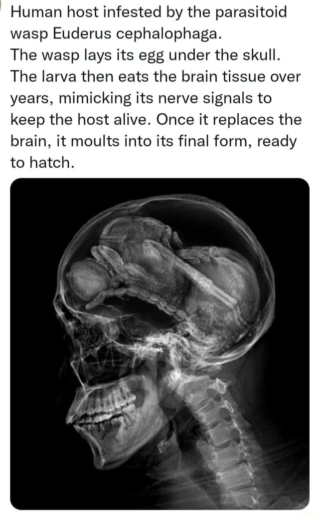Human host infested by the parasitoid wasp Euderus cephalophaga. The ...