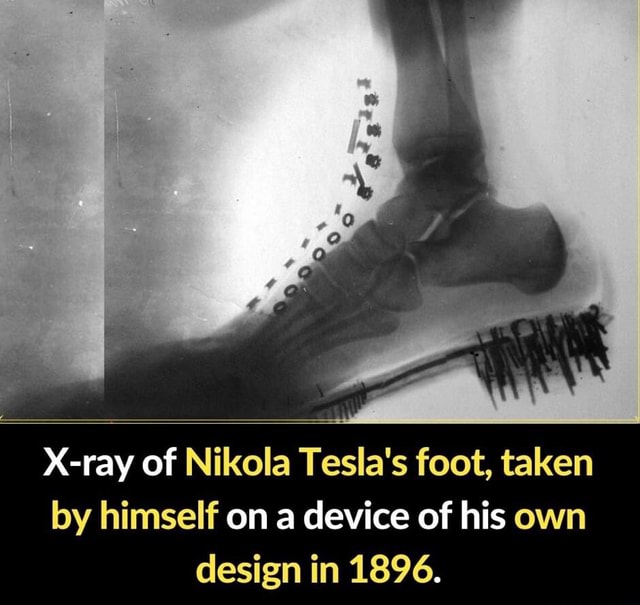 X-ray of Nikola Tesla's foot, taken by himself on a device of his own ...