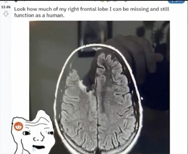 23.0k Look how much of my right frontal lobe I can be missing and still ...