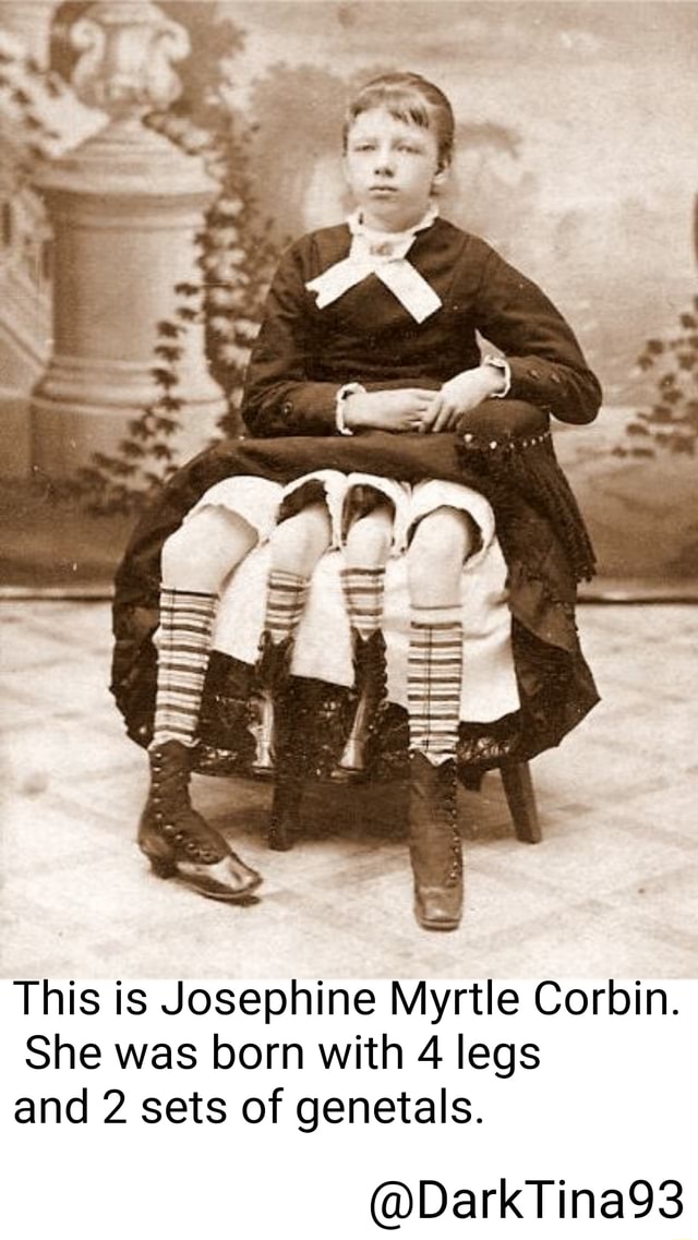 This is Josephine Myrtle Corbin. She was born with 4 legs and 2 sets of ...