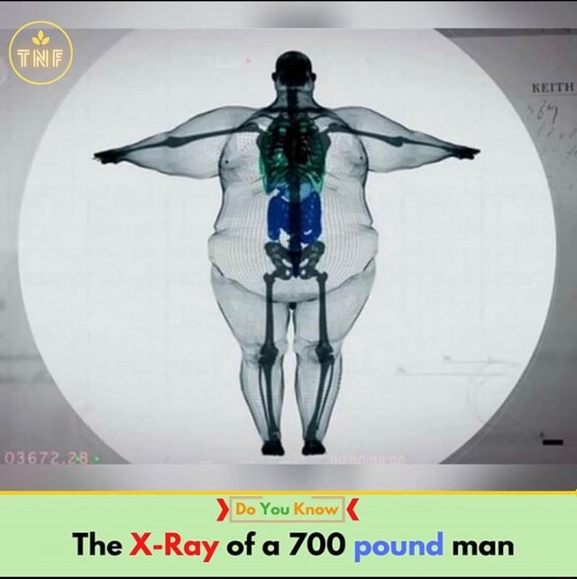 Do You Know The X-Ray of a 700 pound man - iFunny