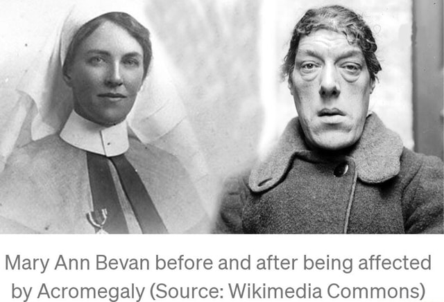 Mary Ann Bevan before and after being affected by Acromegaly (Source ...