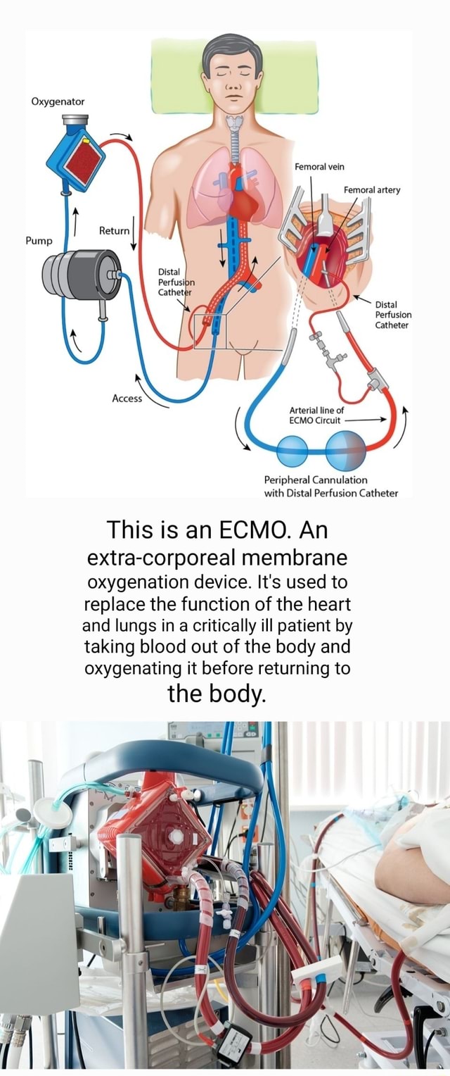 Oxygenator Return Pump Femoral artery Distal Perfusion Catheter ...