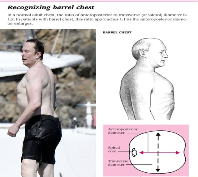 Recognizing barrel chest In a normal adult chest, the ratio of ...