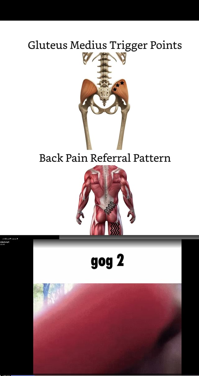 Gluteus Medius Trigger Points Back Pain Referral Pattern - iFunny