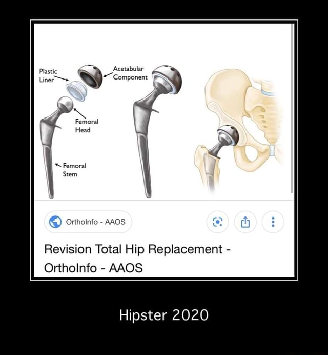 Plastic Acetabular Liner Component Femoral Stem orthoinfo - AAOS Revision Total Hip Replacement ...