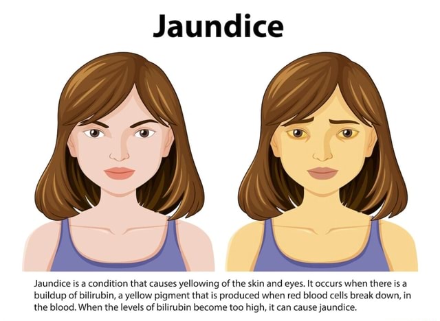 Jaundice Jaundice is a condition that causes yellowing of the skin and eyes. It occurs when ...