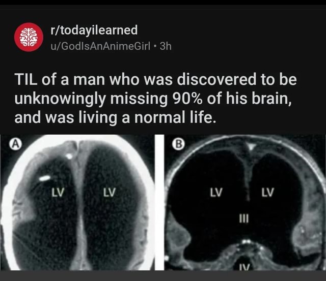 TIL of a man who was discovered to be unknowingly missing 90% of his ...