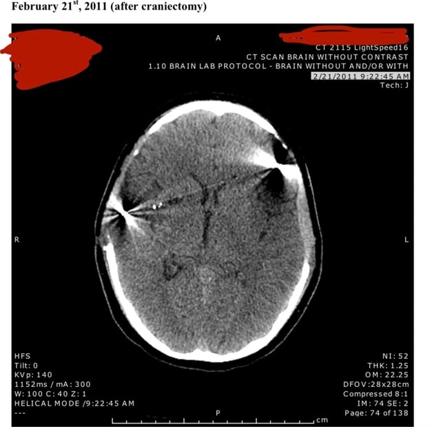 21", 2011 (after CT 2115 LightSpeedi6 Tech: CT SCAN BRAIN WITHOUT CONTRAST 1.10 BRAIN LAB ...