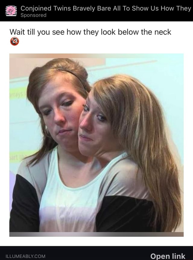 Conjoined Twins Bravely Bare All To Show Us How They Sponsored Wait ...