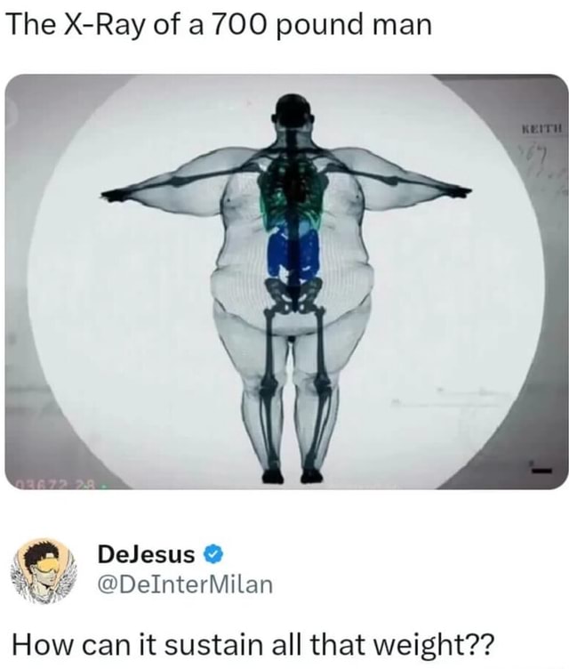 The X-Ray of a 700 pound man DeJesus @ How can it sustain all that ...