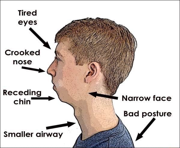 Tired eyes Crooked nose Receding chin Narrow face Bad posture Smaller ...