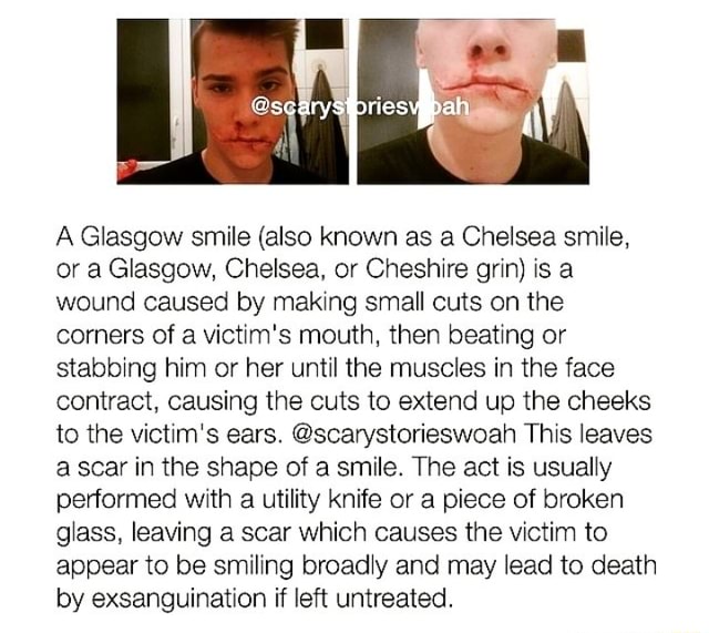 A Glasgow smile (also known as 3 Chelsea smile, or a Glasgow, Chelsea ...