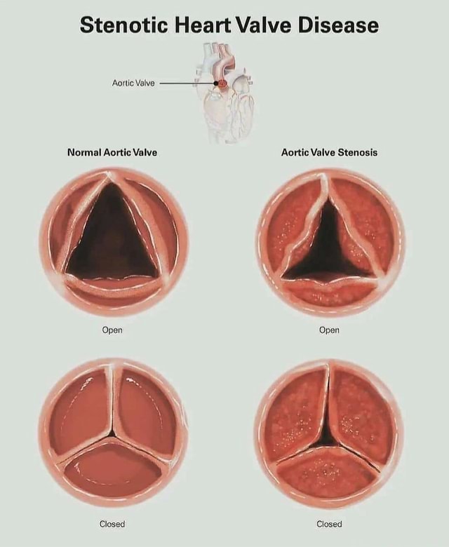 Stenotic Heart Valve Disease Aortic Valve ----_"\-eaalp,_ Normal Aortic ...