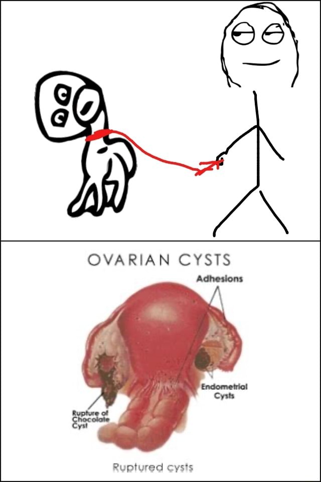 OVARIAN CYSYS - iFunny