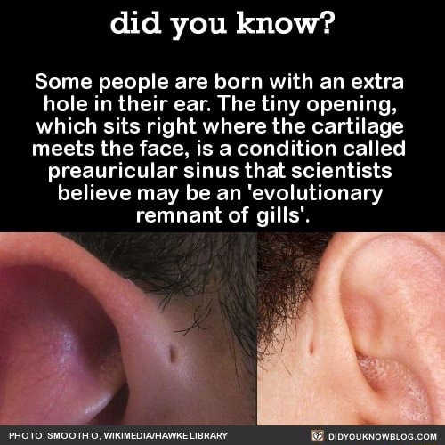 Did You Know Some People Are Born With An Extra Hole In Their Ear The